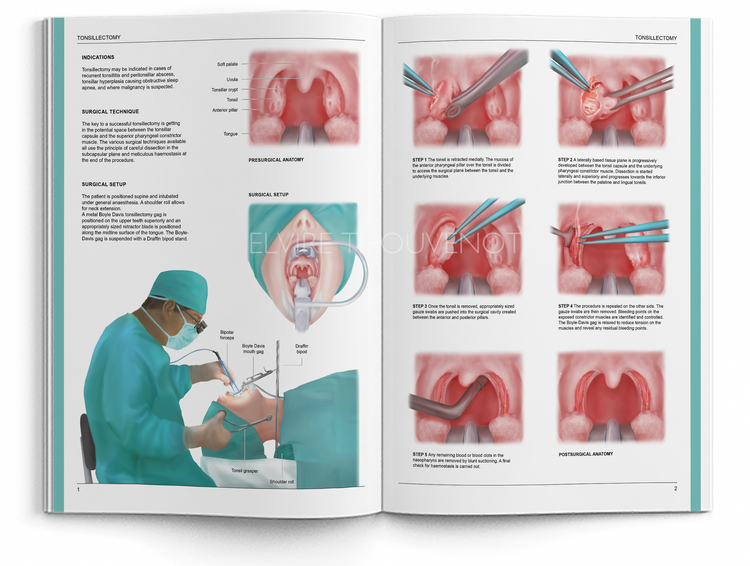 Tonsillectomy - Illustrated Surgical Sequence — ELVIRE THOUVENOT