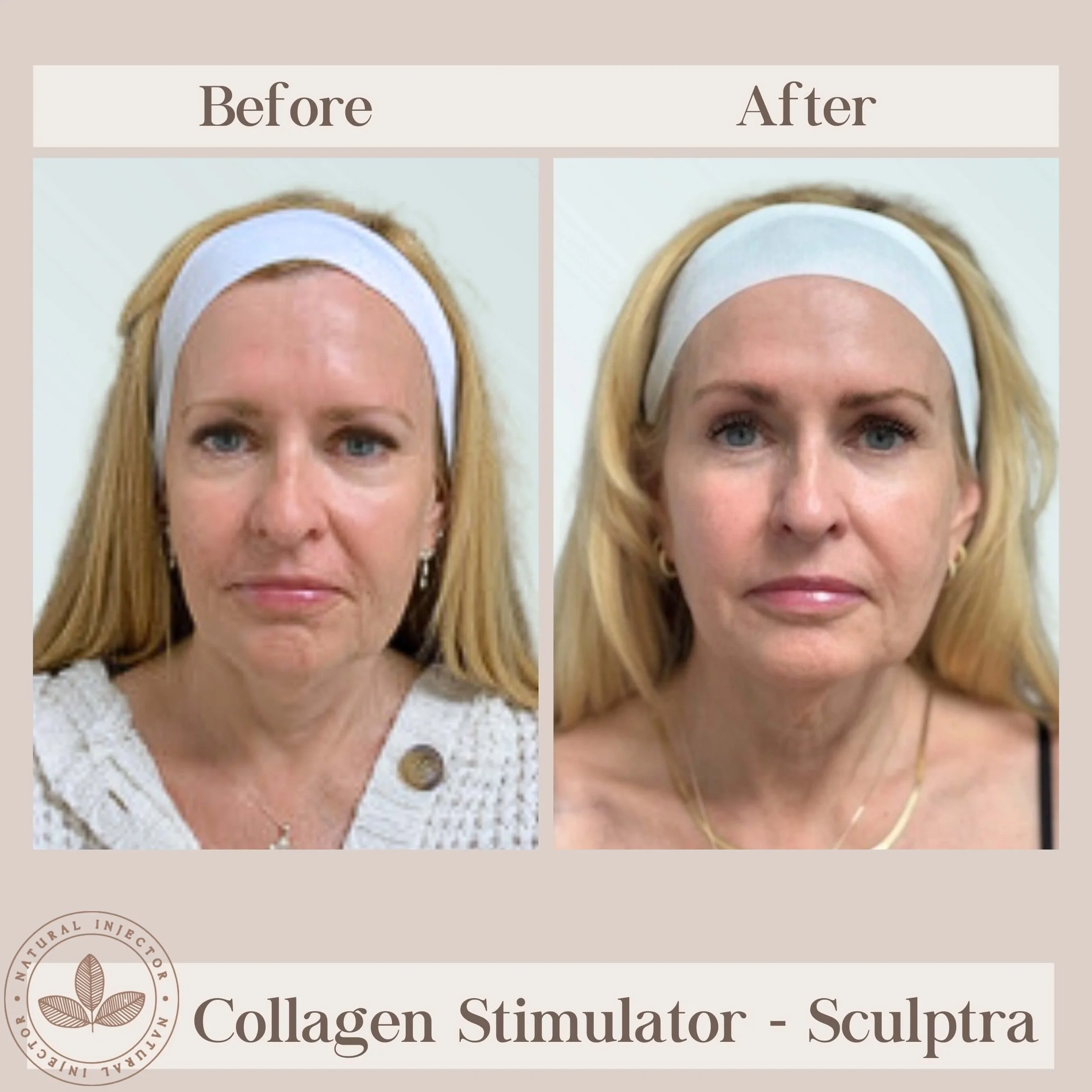 Before & After - Collagen Stimulators — Natural Injector