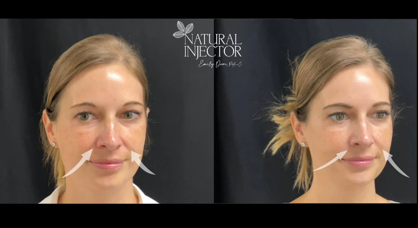 Botox Before And After Smile Lines