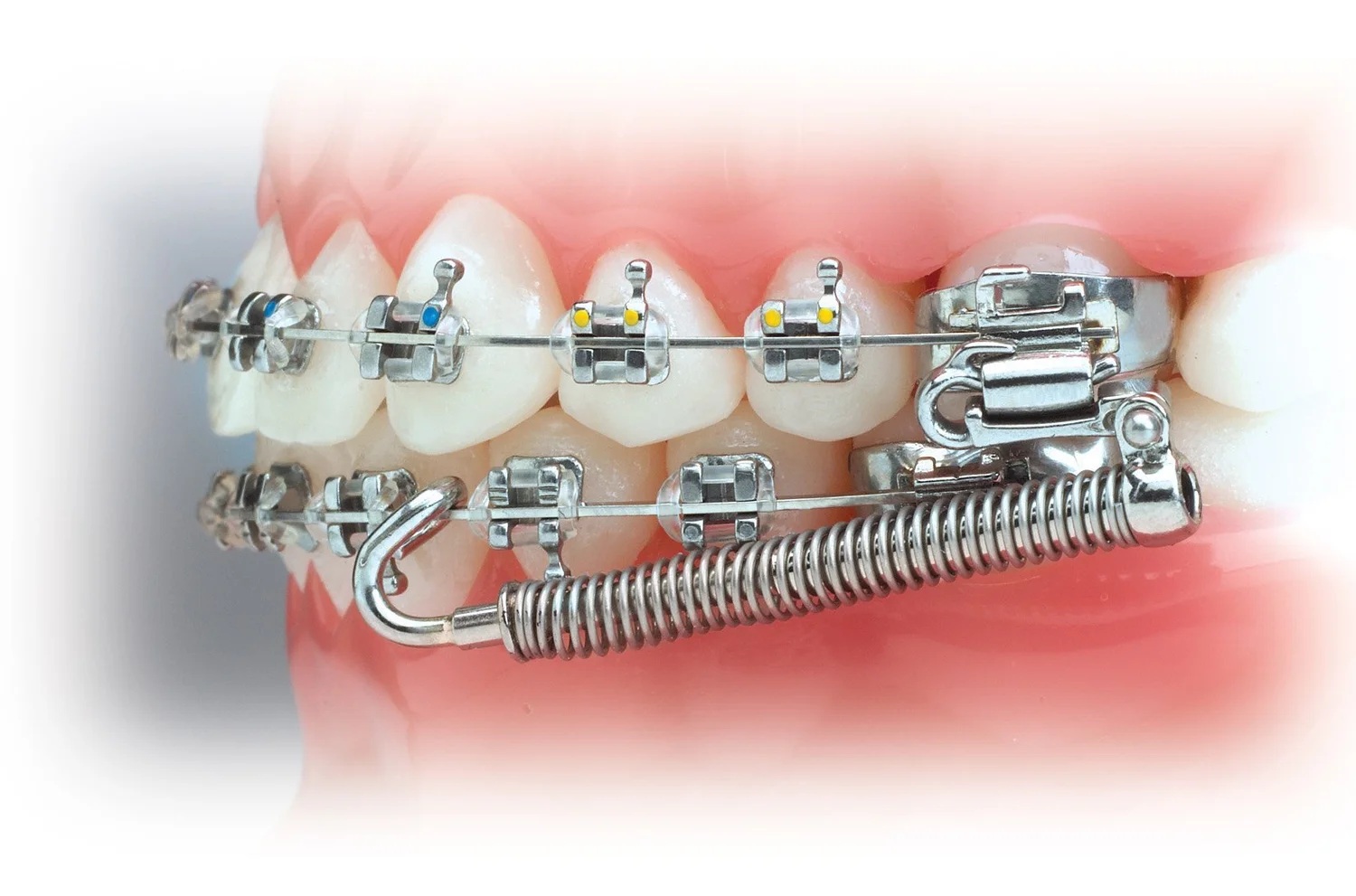 Appliances Overview — Tri-Valley Orthodontics