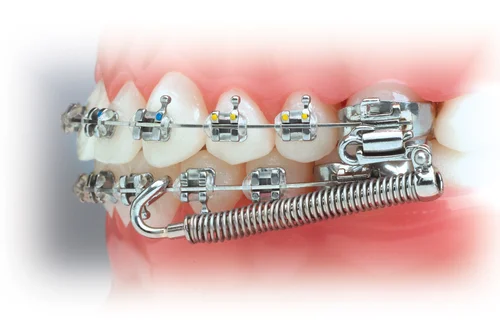 Appliances Overview — Tri-Valley Orthodontics