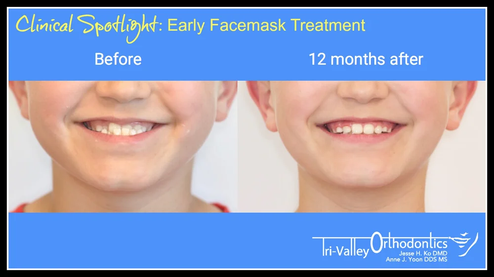 Clinical Spotlight: Facemask — Tri-Valley Orthodontics