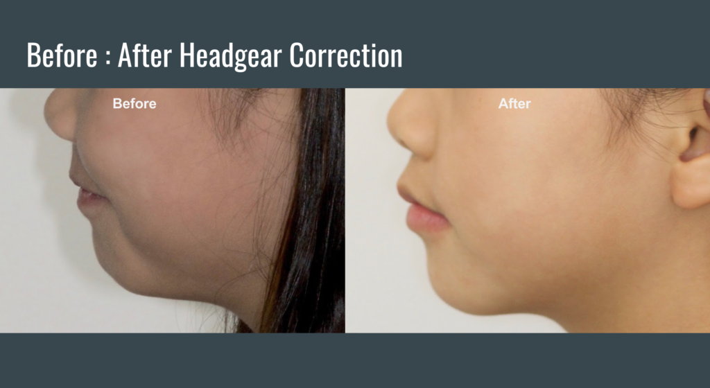 Clinical Spotlight: Headgear — Tri-Valley Orthodontics