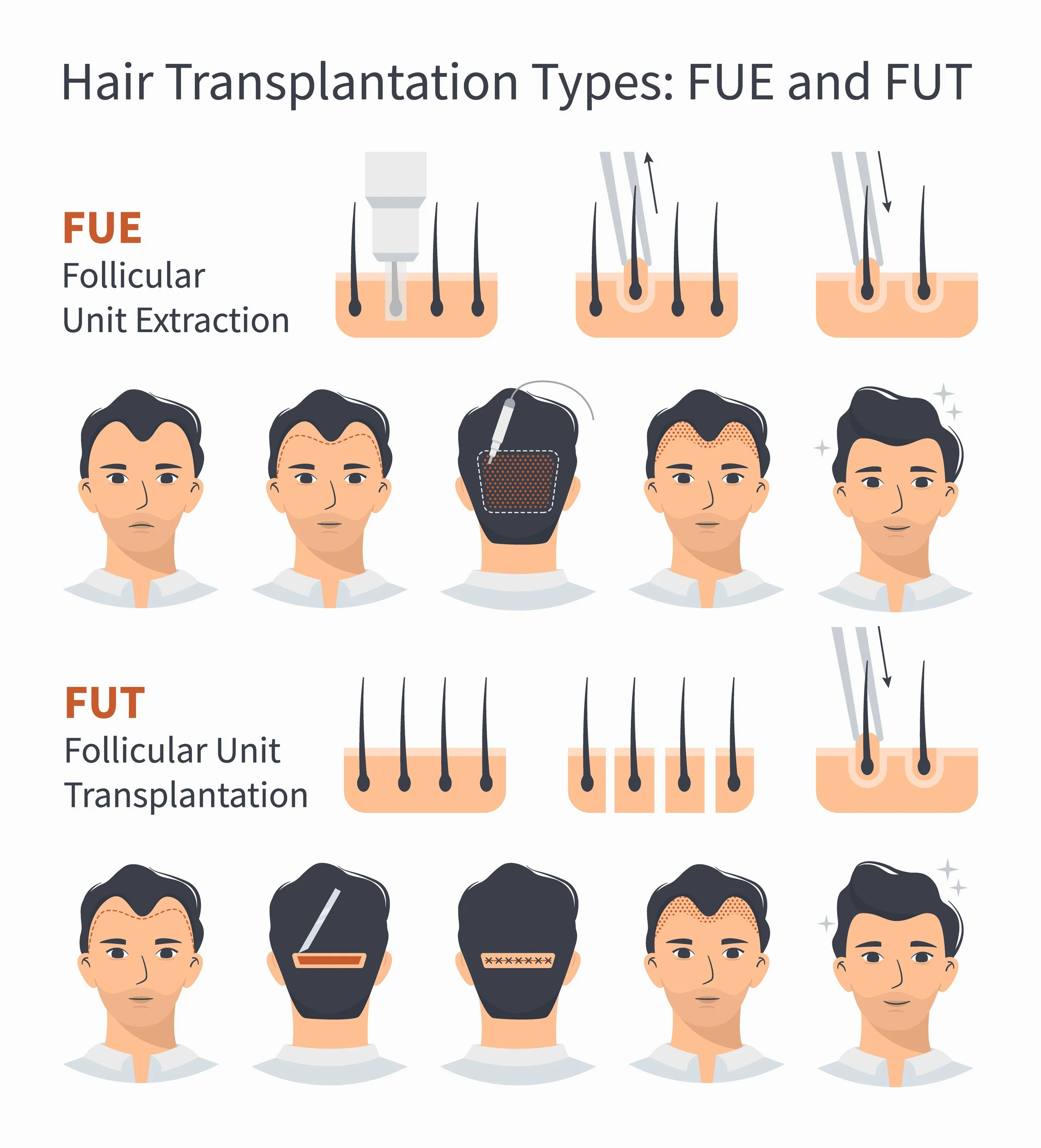 Follicular Unit Extraction - FUE — Lansing Hair Restoration