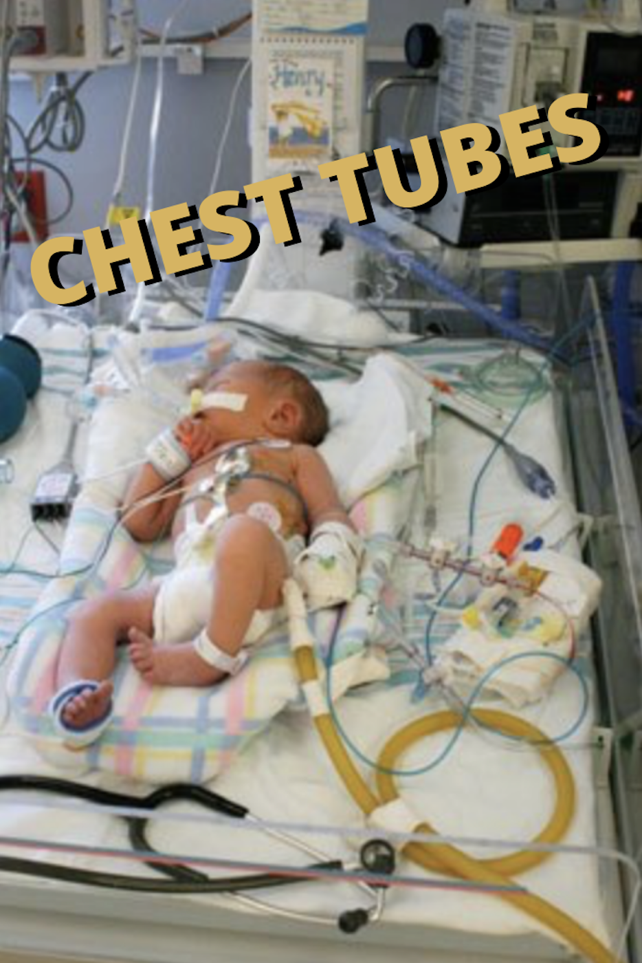 Chest Tubes — THE NURSE NATALIE
