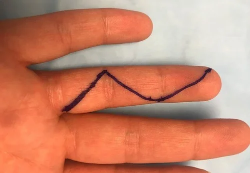 WHAT TO DO WHEN YOU CUT YOUR FINGER AND IT WON’T BEND — Dominion ...