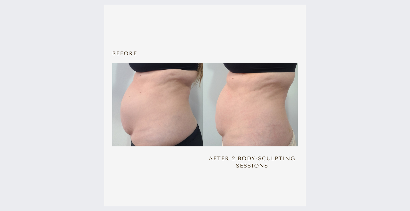 Body Sculpting — PROSKIN AESTHETICS