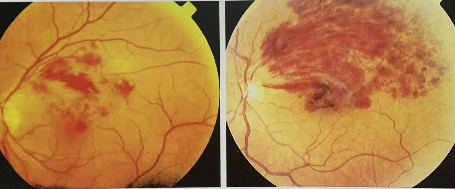 Trombosis ocular — ceoval