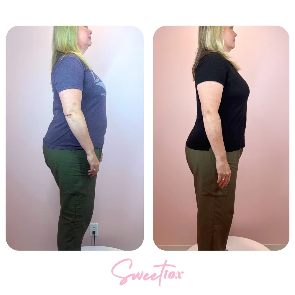 Milwaukee's Favorite Filler & Botox | Sweet Tox Menomonee Falls