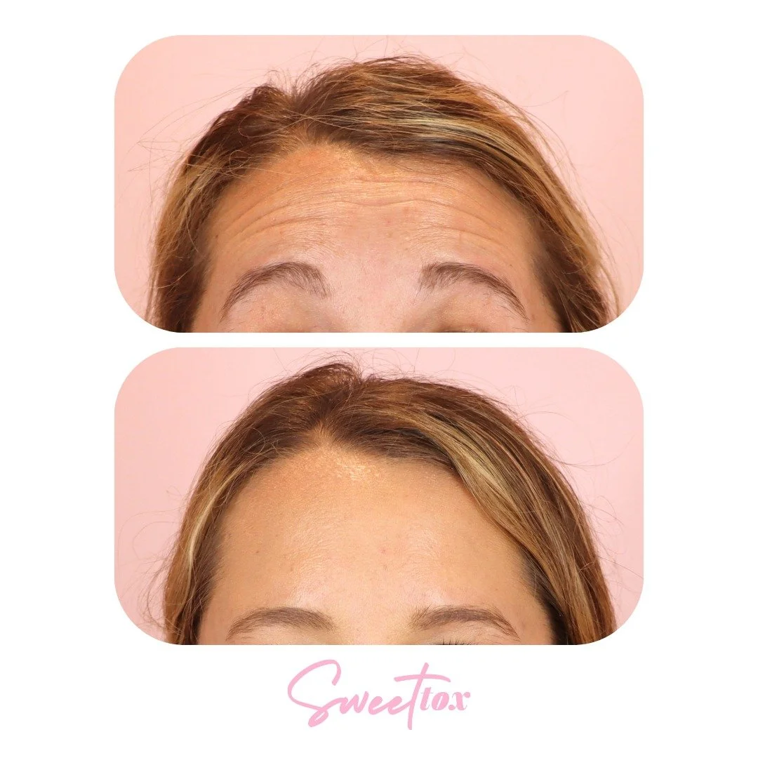 Milwaukee's Favorite Filler & Botox | Sweet Tox Menomonee Falls