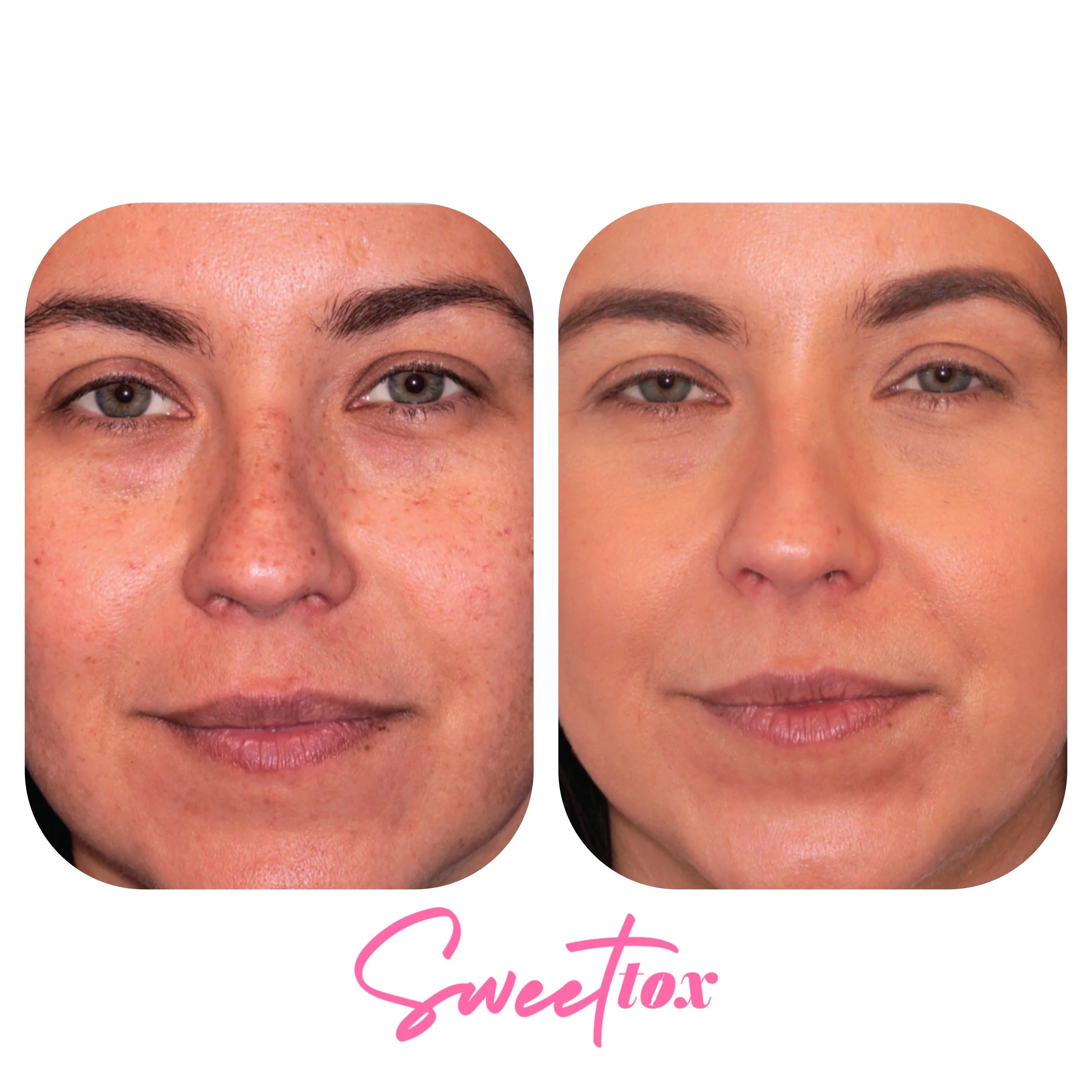 Medical Laser Treatments in Milwaukee, Wisconsin | Sciton BBL Forever ...