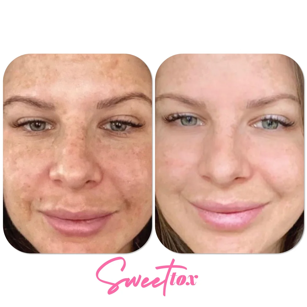 Medical Laser Treatments in Milwaukee, Wisconsin | Sciton BBL Forever ...