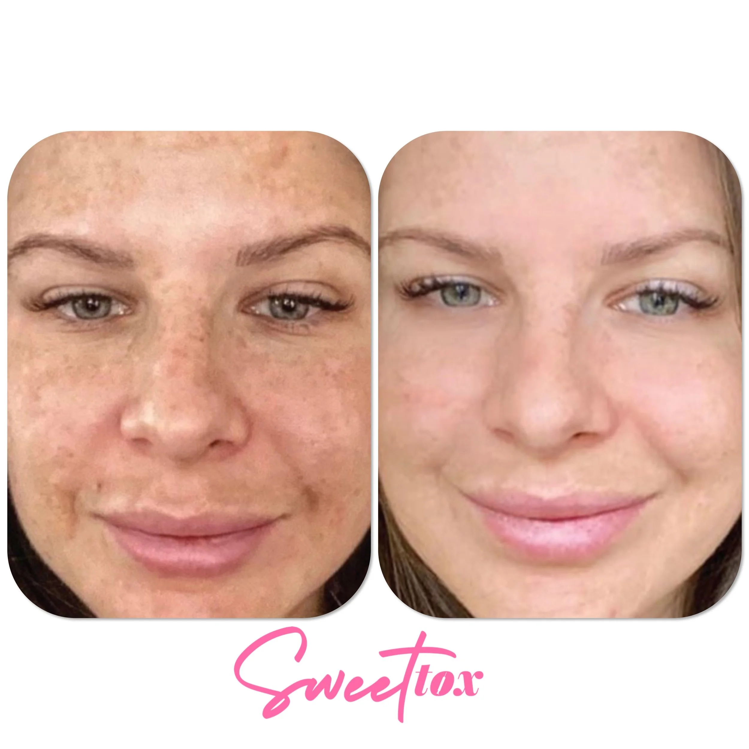 Medical Laser Treatments in Milwaukee, Wisconsin | Sciton BBL Forever ...