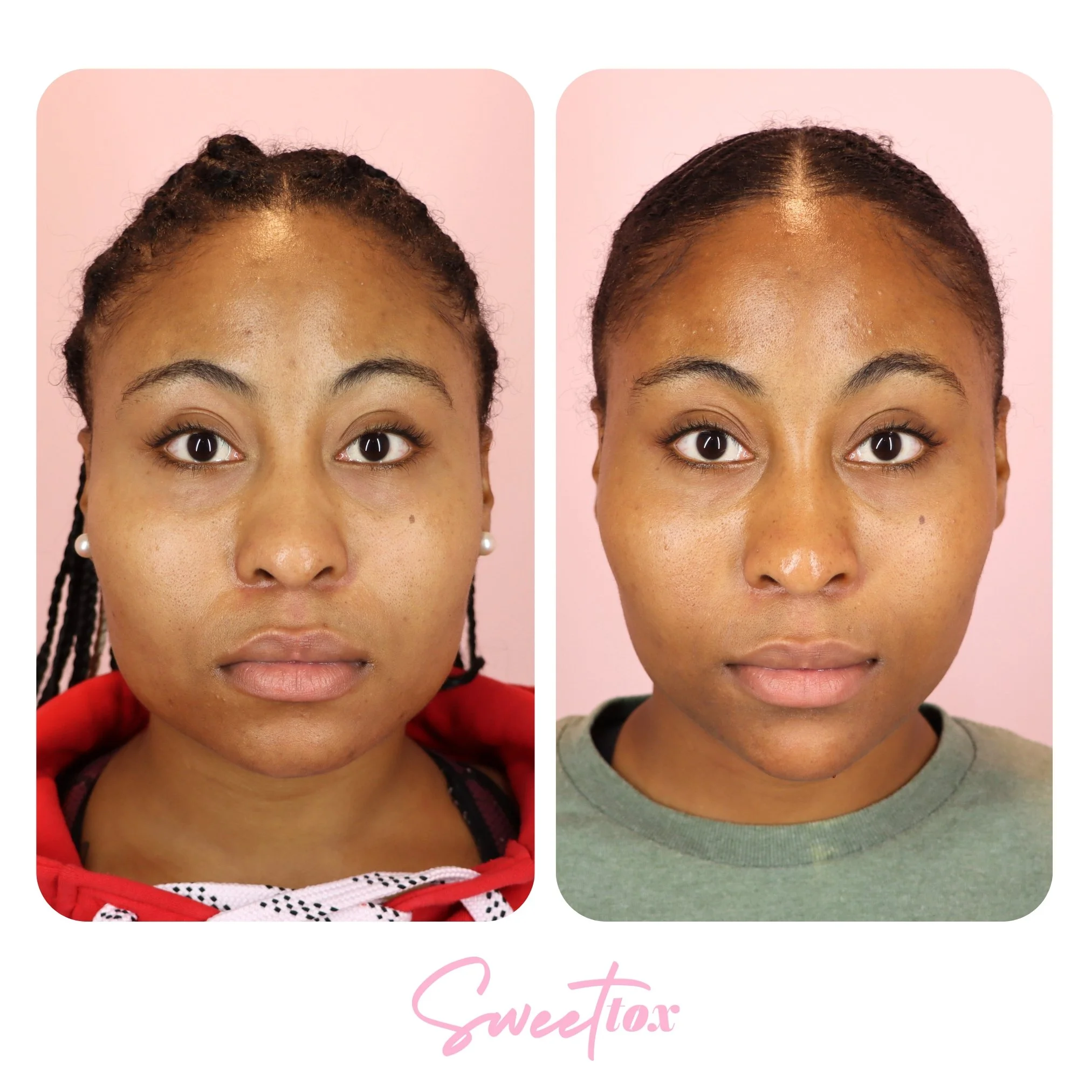 Milwaukee's Favorite Filler & Botox | Sweet Tox Menomonee Falls