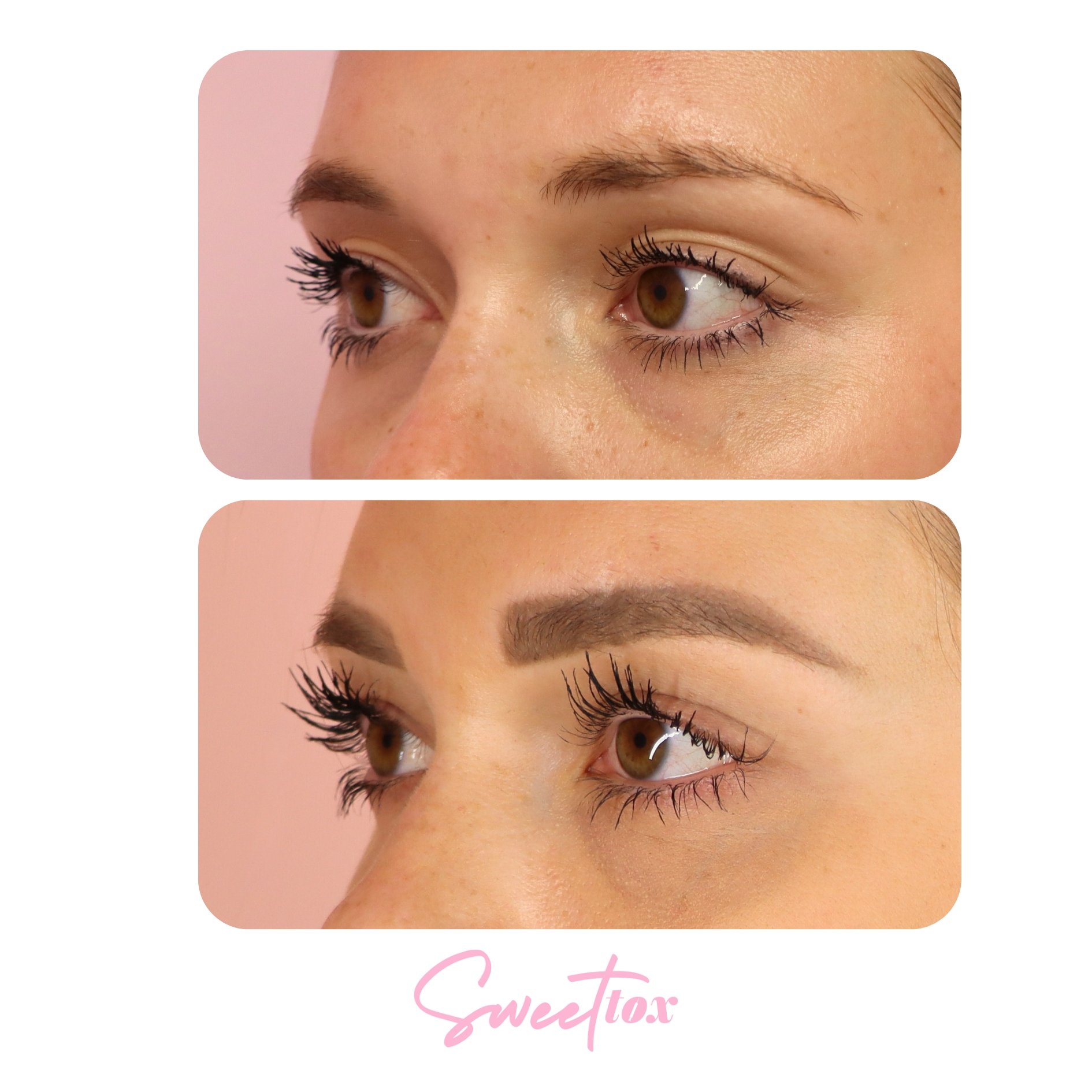 Milwaukee's Favorite Filler & Botox | Sweet Tox Menomonee Falls