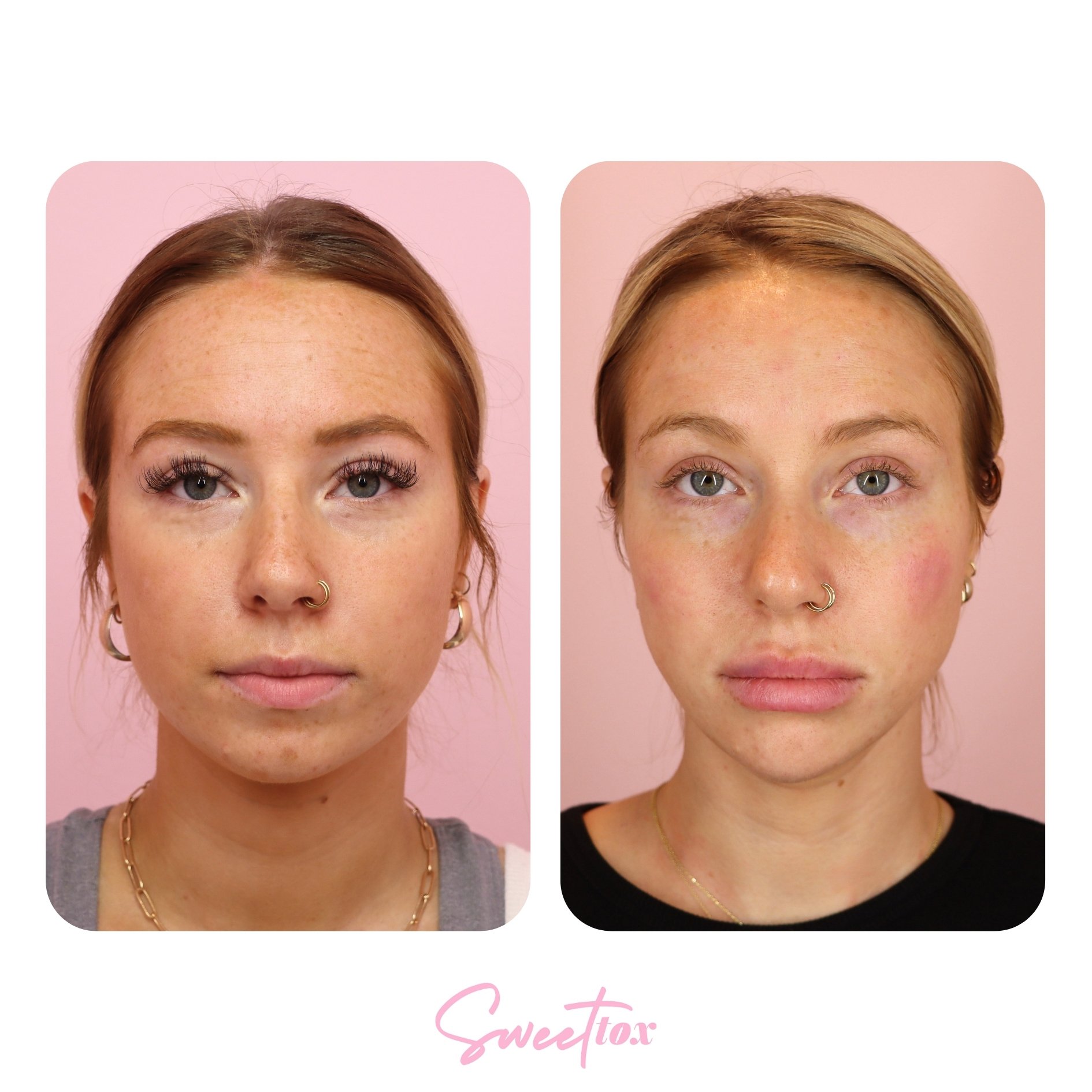 Milwaukee's Favorite Filler & Botox | Sweet Tox Menomonee Falls