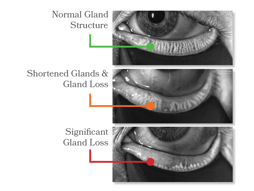 Eyelid Glands