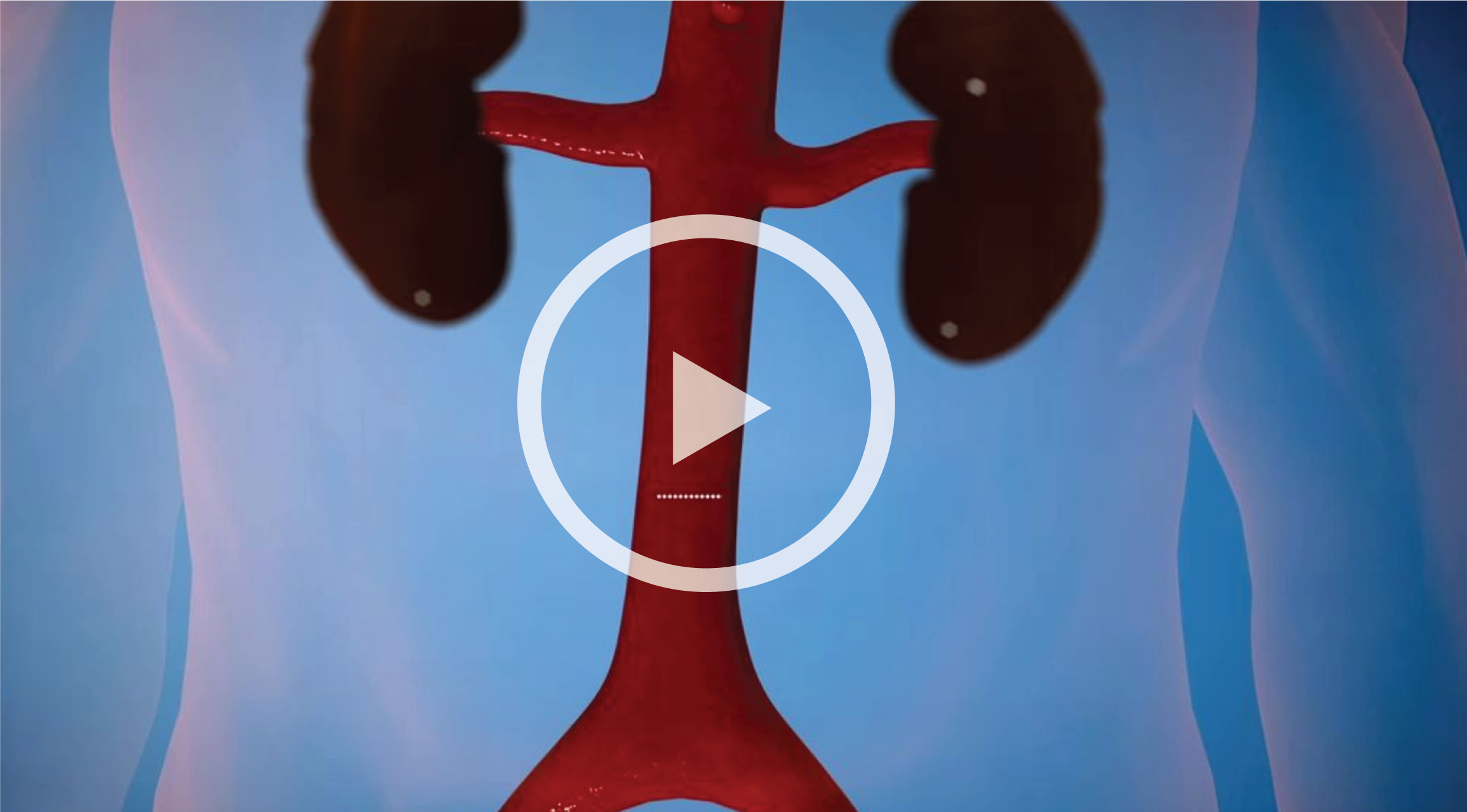 Technology — Nectero Medical