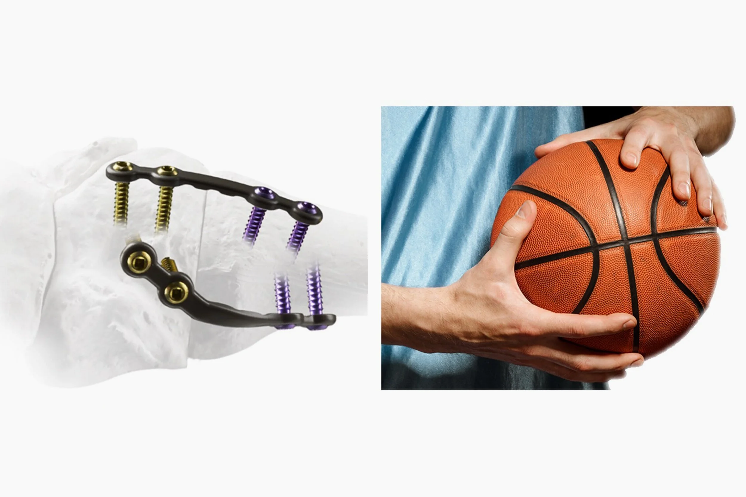 Dr. Paul Steinke - Lapiplasty® 3D Bunion Correction – Home