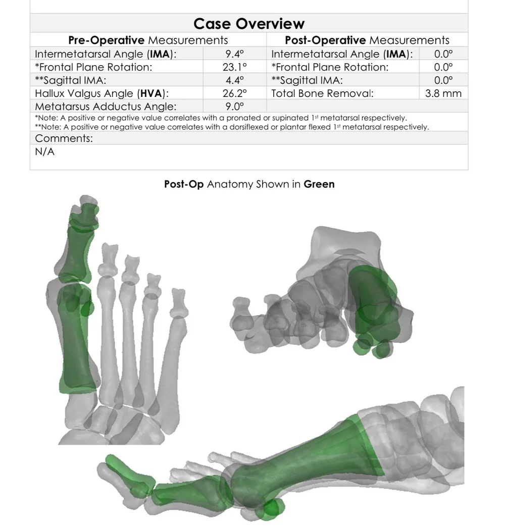 Bunion Surgery: reduced surgery time, more precise results and the best ...