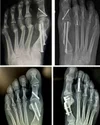 What are the differences between MIS(Minimal Incision) Bunion Surgery ...