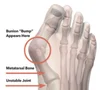 Lapiplasty®: A Superior Option in Minimally Invasive Bunion Surgery ...