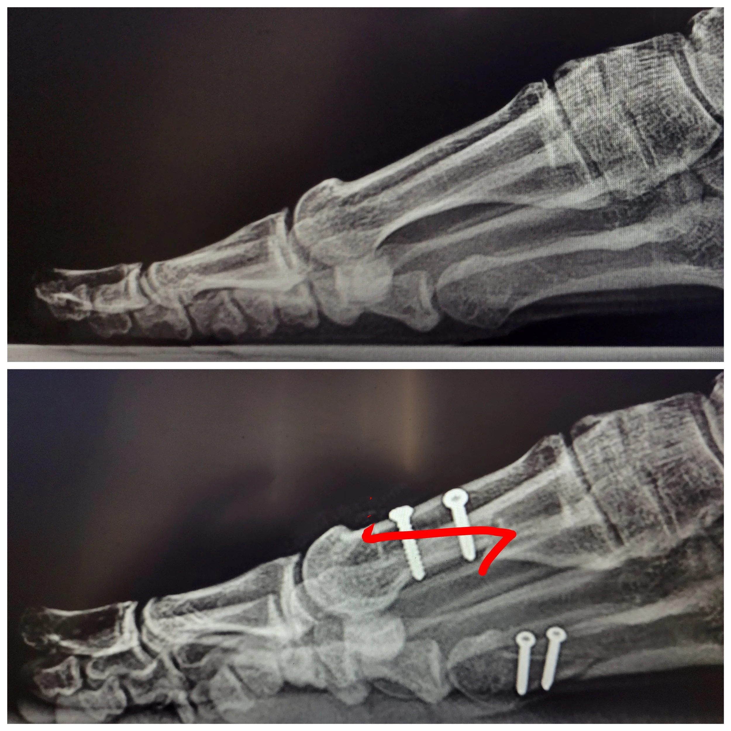 How soon can I walk after bunion correction? Can I walk the same day ...
