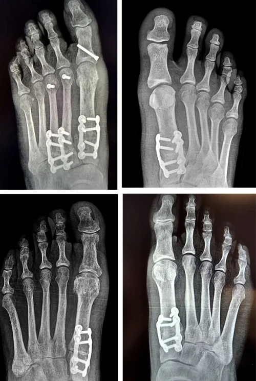 What are the differences between MIS(Minimal Incision) Bunion Surgery ...