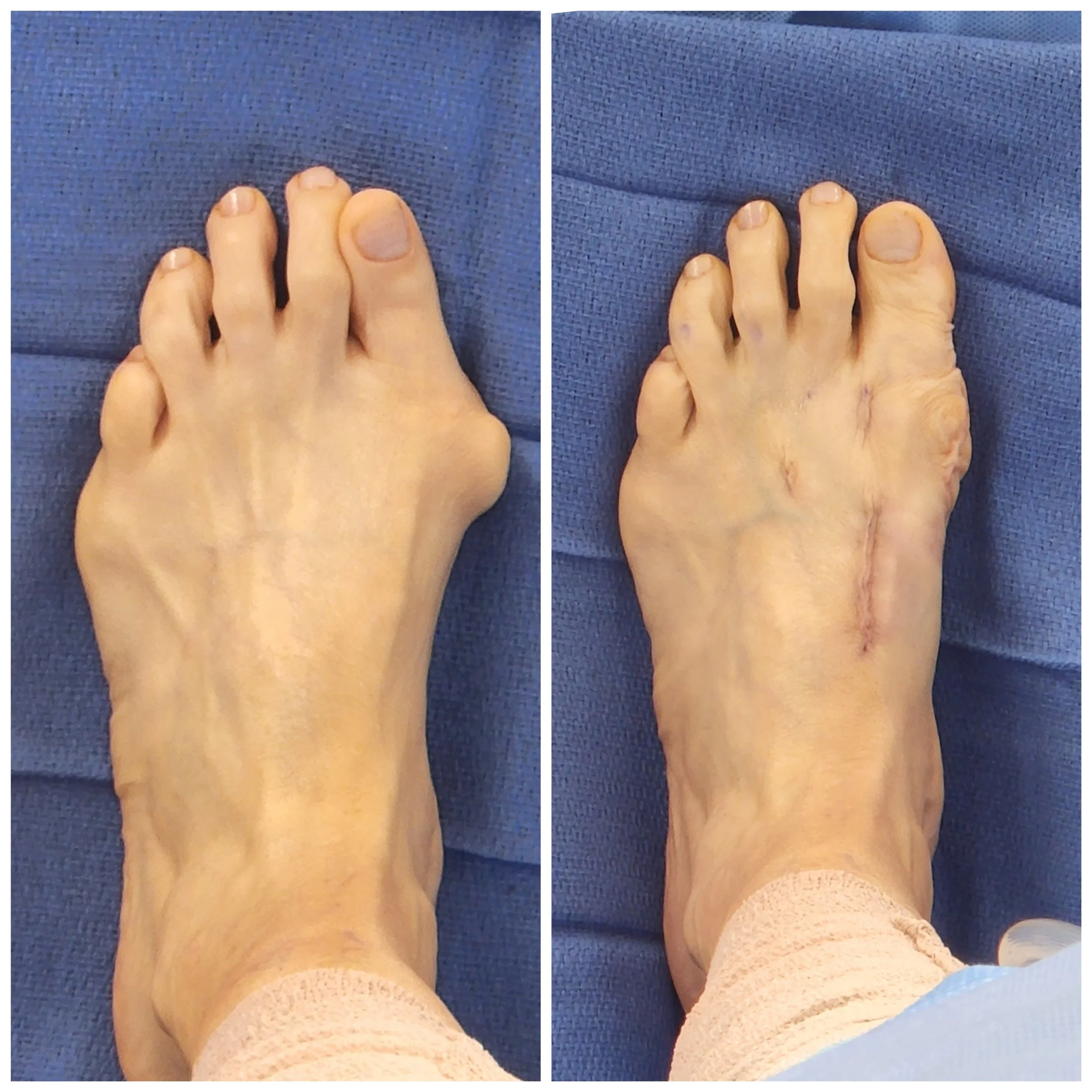 How to Choose the Right Surgeon for Your Bunion Surgery — Dr. Paul ...