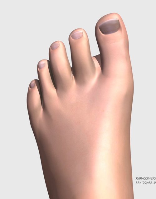 What are the differences between MIS(Minimal Incision) Bunion Surgery ...