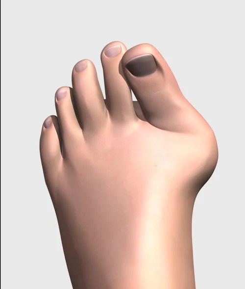 What are the differences between MIS(Minimal Incision) Bunion Surgery ...