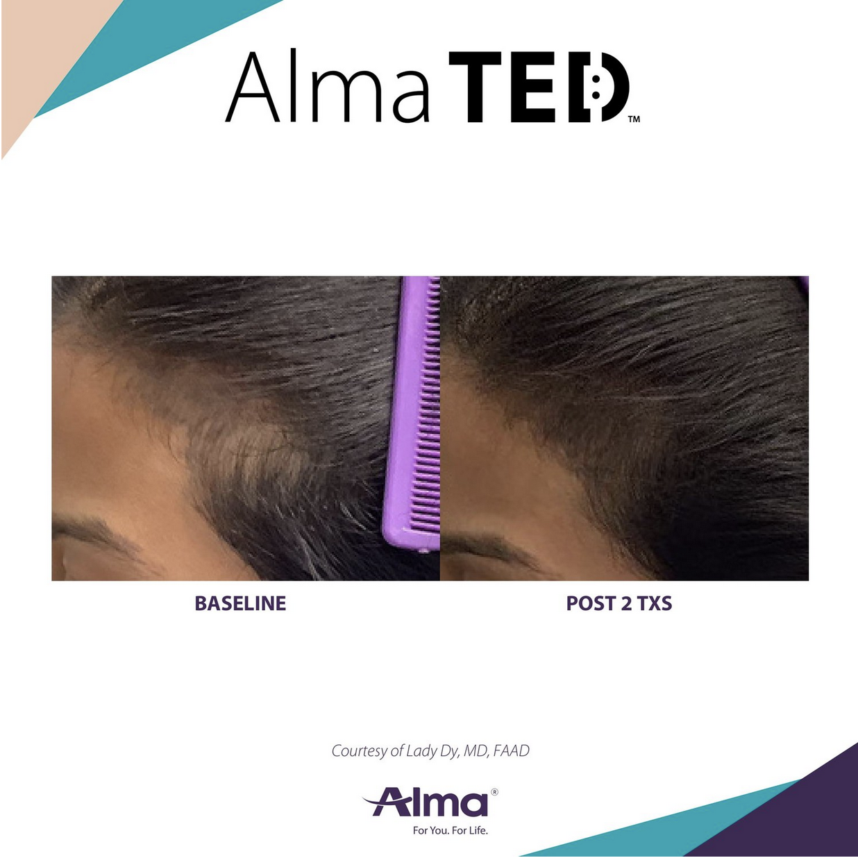Alma TED Hair Restoration | Hair Regrowth — SageMED