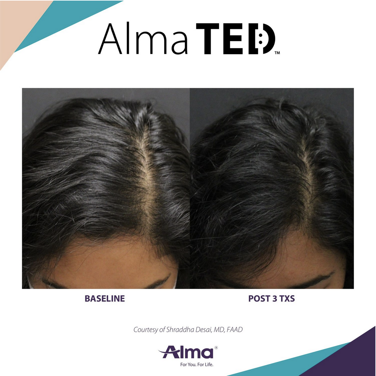 Alma TED Hair Restoration | Hair Regrowth — SageMED