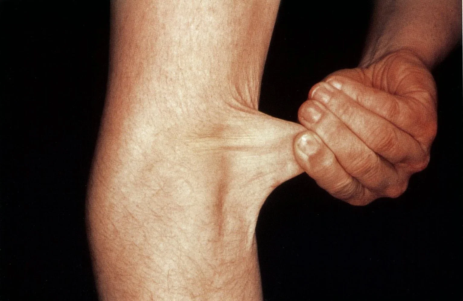 Ehlers-Danlos Syndrome: Symptoms & Causes — SageMED