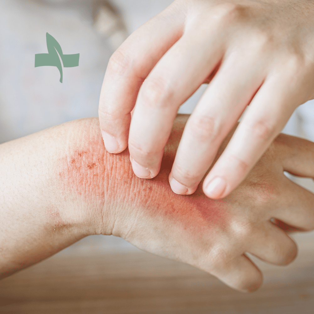 Winter Rash: Causes, Symptoms, and Treatments — SageMED
