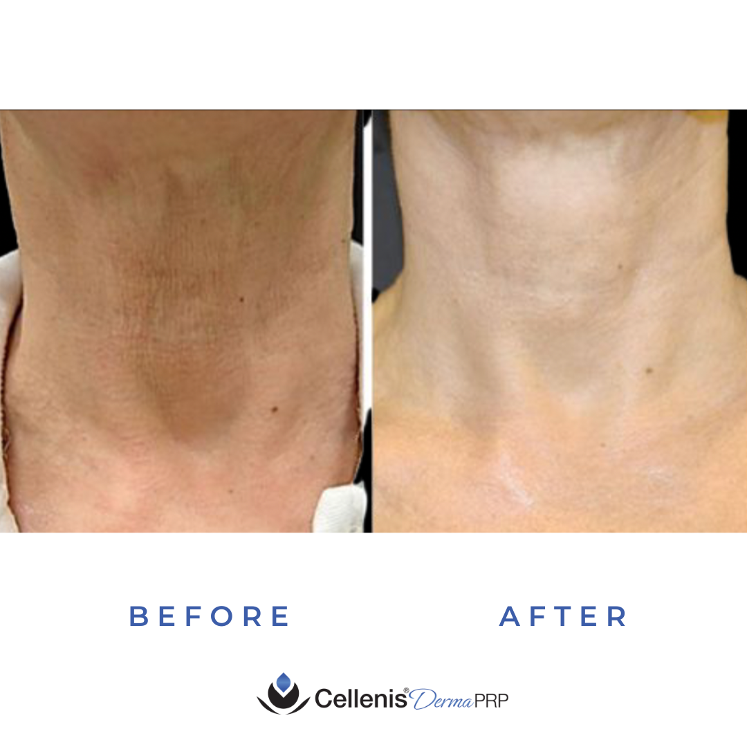 Cellenis® Derma PRP — SageMED