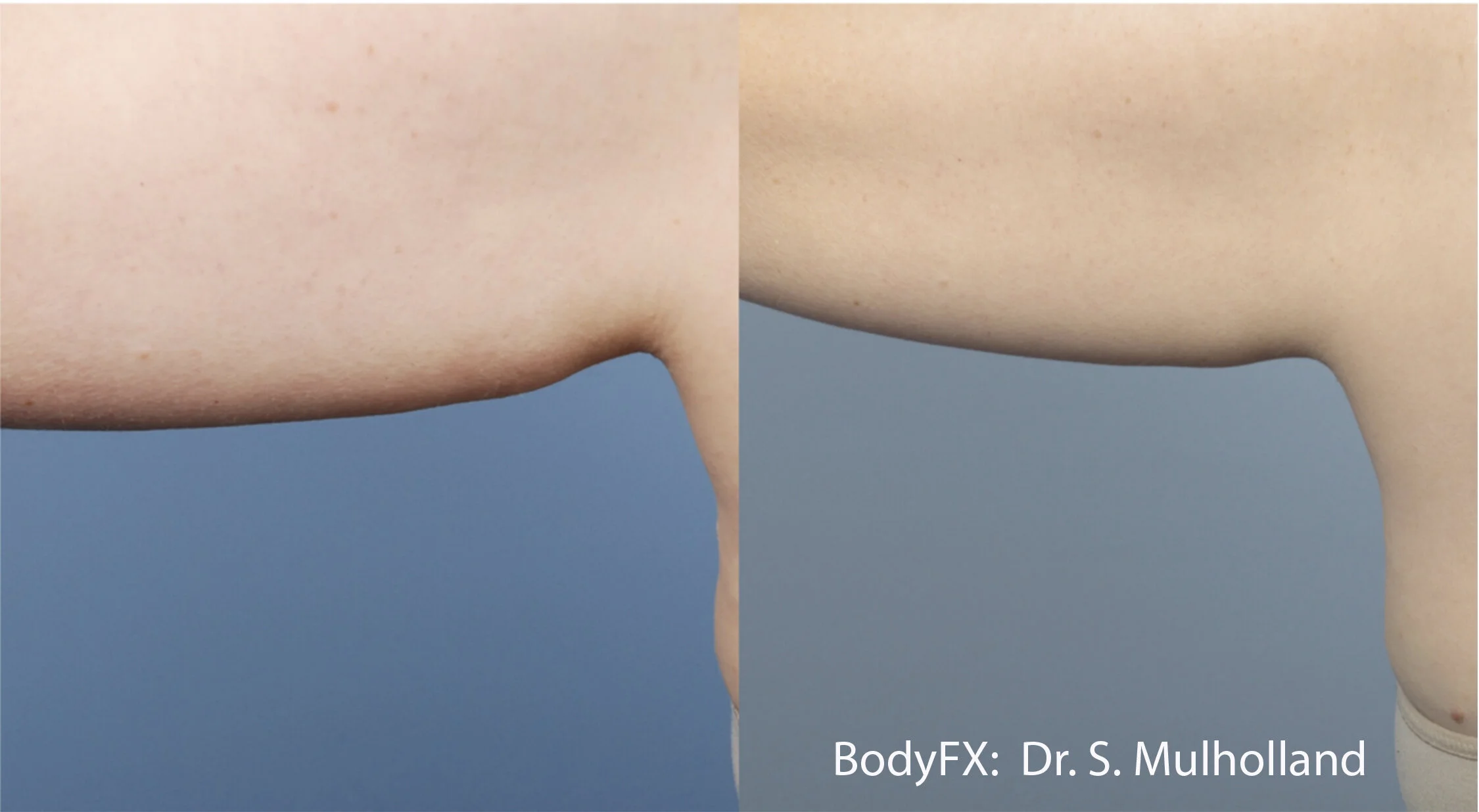 Body FX Treatment in Cambridge, ON | Mimada Beauty — Mimada Beauty ...