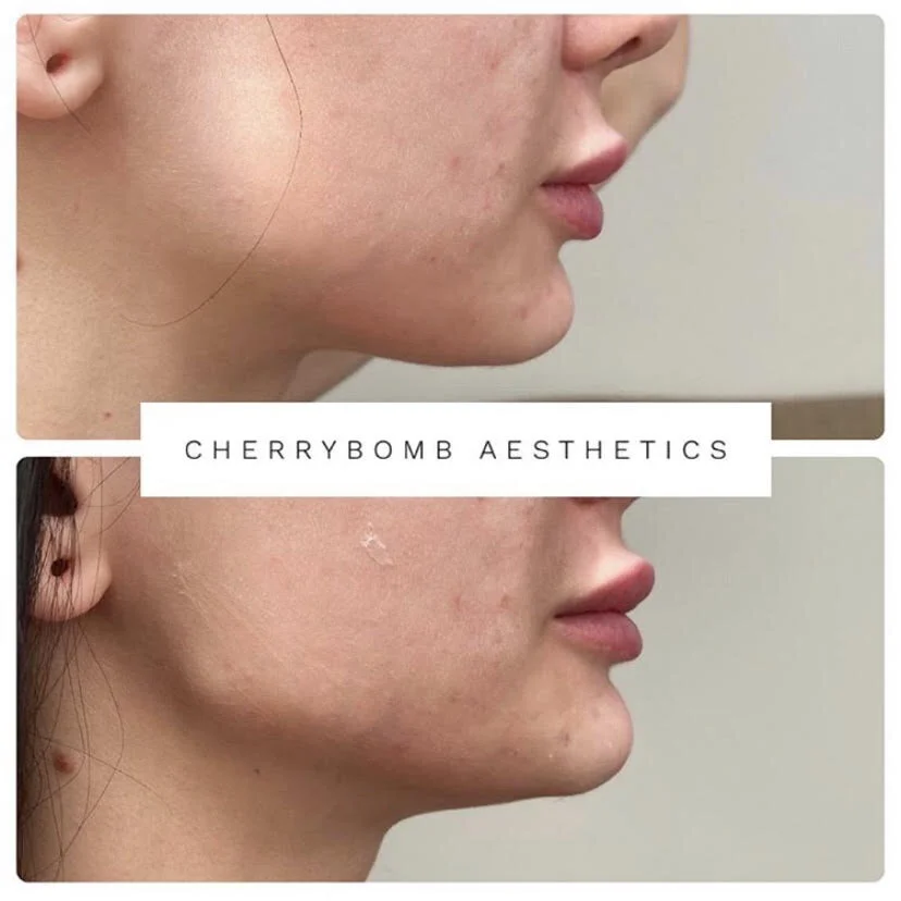 Procedure Before And After CherryBomb Aesthetics 07505490127 procedure-before-and-after-cherrybomb-aesthetics-07505490127