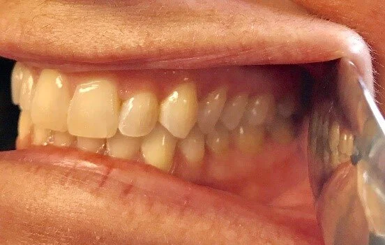 Virtual Consultation | Find Out Cost | Braces Questions Answered