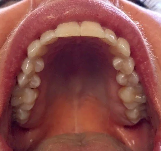 Virtual Consultation | Find Out Cost | Braces Questions Answered ...