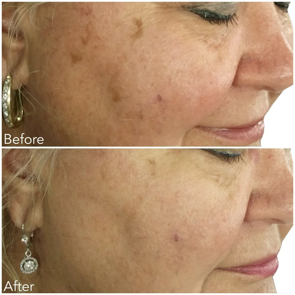 IPL for Pigmentation or Vascular — Designing Faces