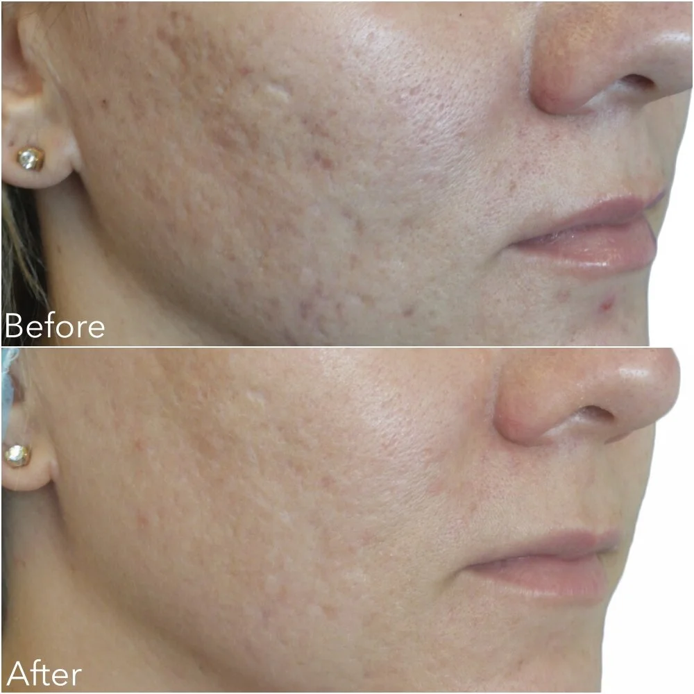 Skin Resurfacing Newcastle | Skin Treatments — Designing Faces