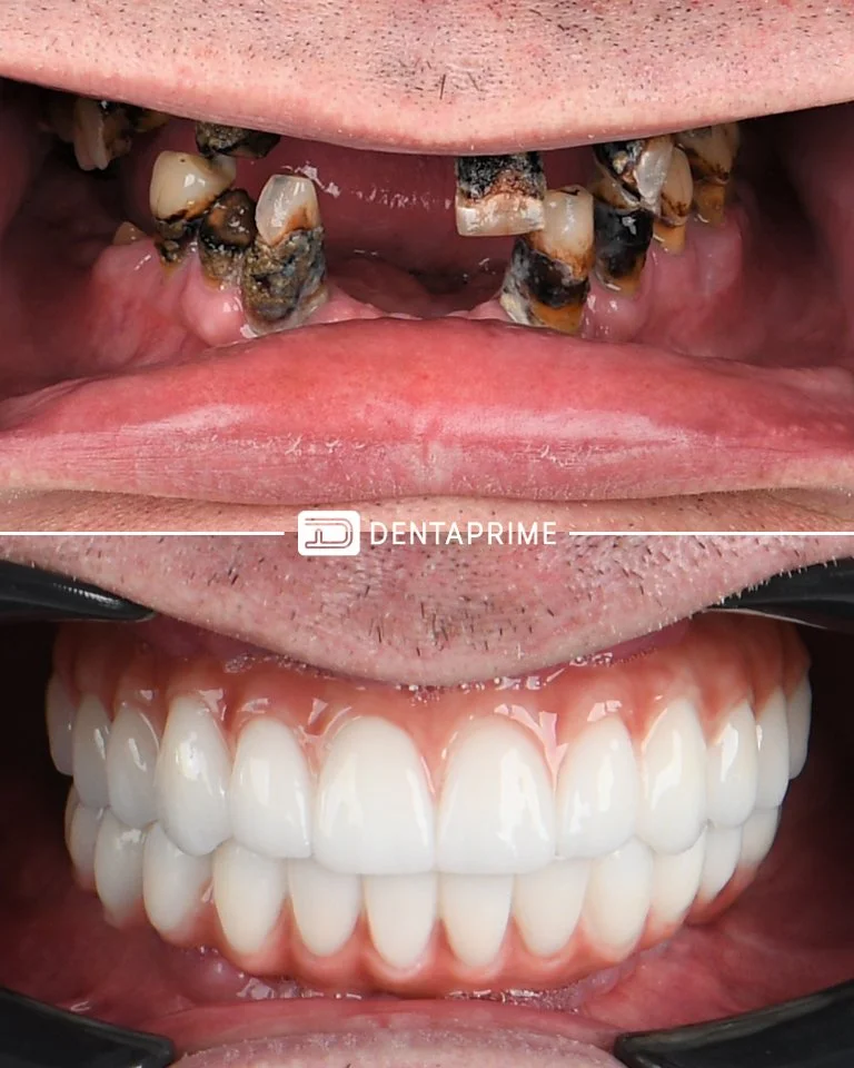 Dental implants or dentures - tooth loss solutions for seniors ...