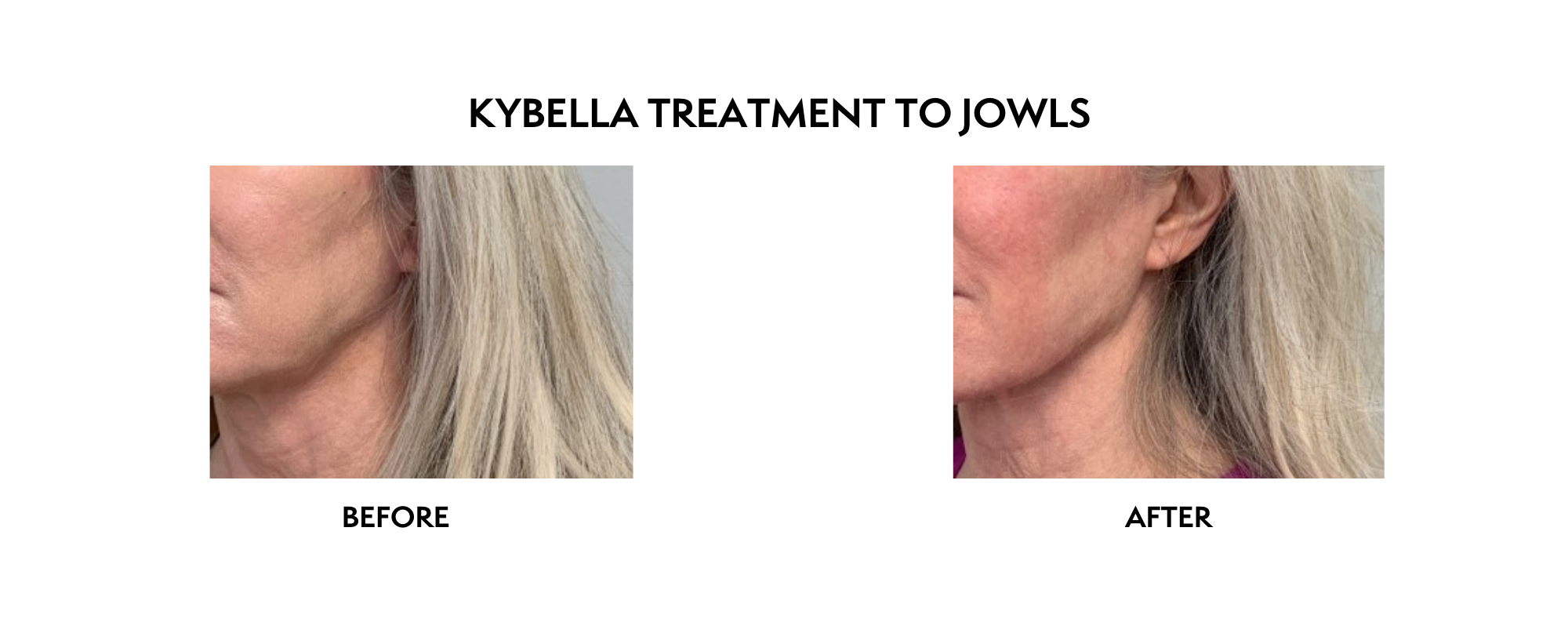 Kybella Double Chin Treatment | North Bethesda, MD