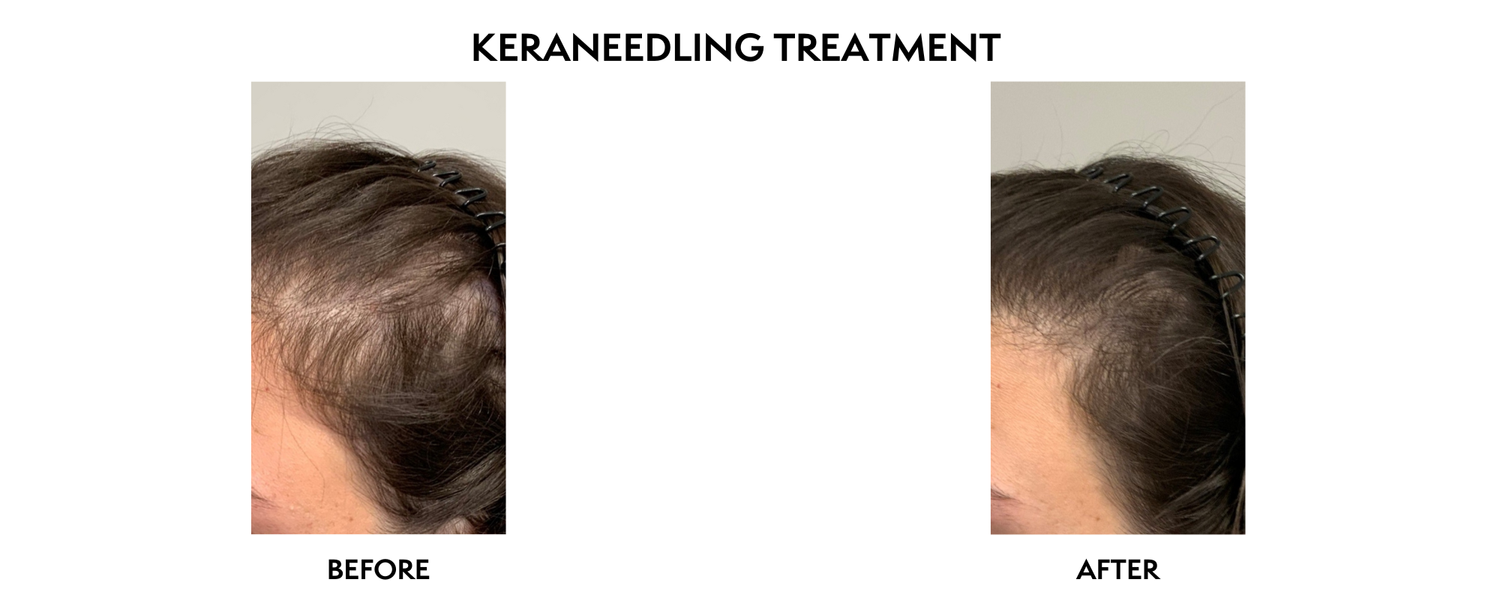 Kerafactor | Hair Growth Treatment | North Bethesda, MD