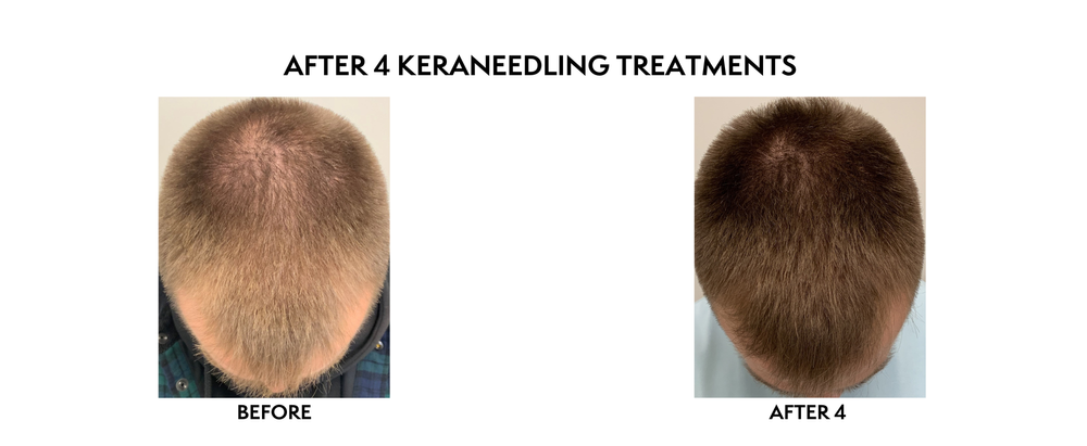 Kerafactor | Hair Growth Treatment | North Bethesda, MD