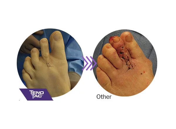 Before & After Hammertoe Photos | TenoTac® — TenoTac®