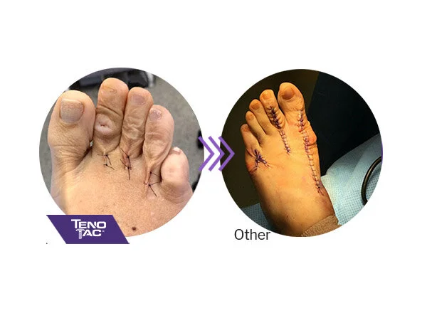 Before & After Hammertoe Photos | TenoTac® — TenoTac®