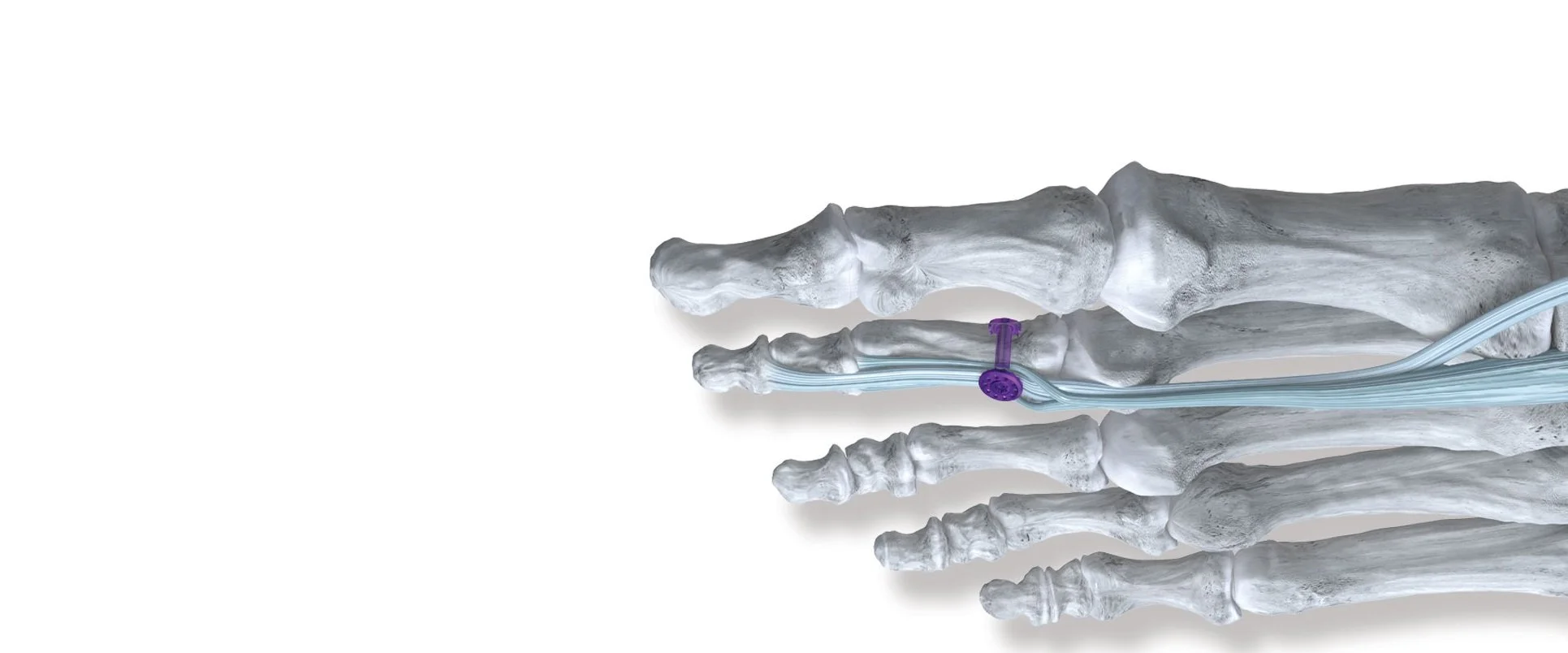 Surgeons | TenoTac® — TenoTac®