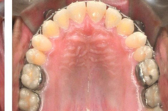 Orofacial Myofunctional Disorders (OMD) are often unrecognized in ...